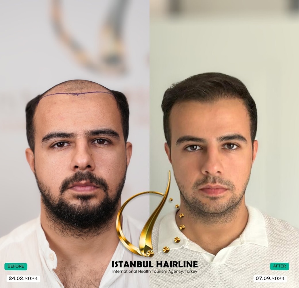 Saç Ekimi İstanbul | Ücretsiz Analiz | İstanbul Hairline – Saç Ekimi ...